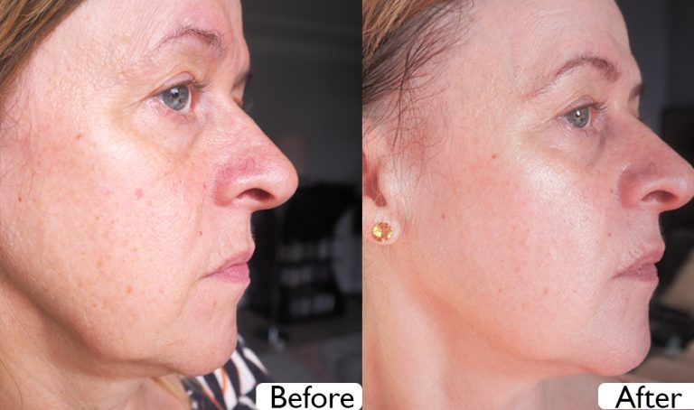 CurrentBody Skin RF Radio Frequency Skin Tightening Device review + 10% ...