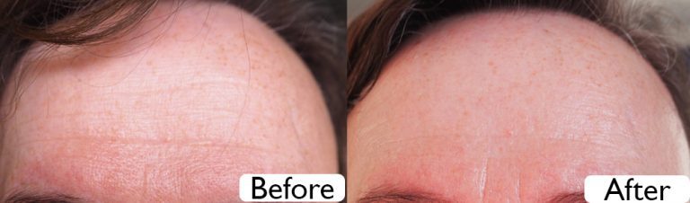 CurrentBody Skin RF Radio Frequency Skin Tightening Device review + 10% ...
